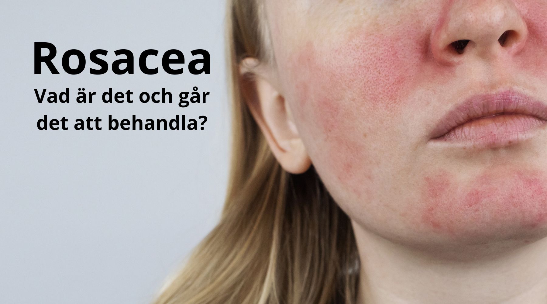Rosacea - Orsaker symptom och hur den behandlas – rosalieve